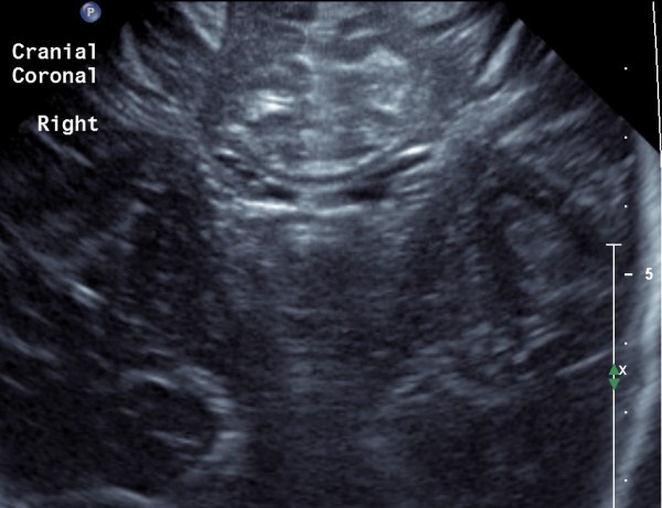 Connatal cysts -Neonatal cranial ultrasound | Pediatric Ultrasound A ...