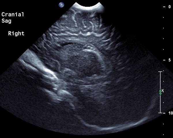 Connatal cysts -Neonatal cranial ultrasound | Pediatric Ultrasound A ...