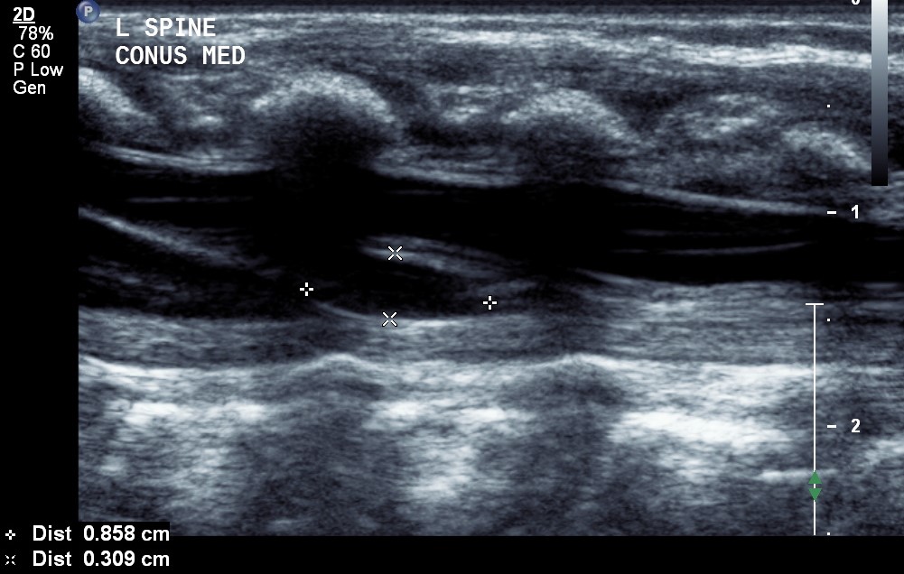 Spinal Ultrasound -normal variants | Pediatric Ultrasound A Practical Guide