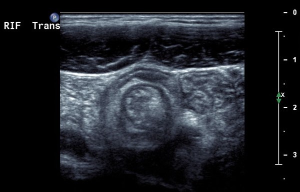 Small Bowel Intussusception | Pediatric Ultrasound A Practical Guide