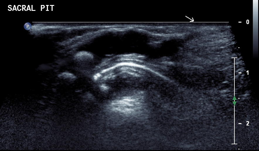 Spinal Ultrasound -Normal Variants -part 2 | Pediatric Ultrasound A ...
